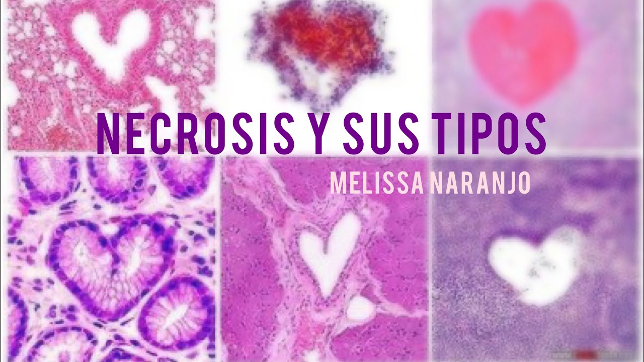 NECROSIS Y SUS TIPOS - YouTube