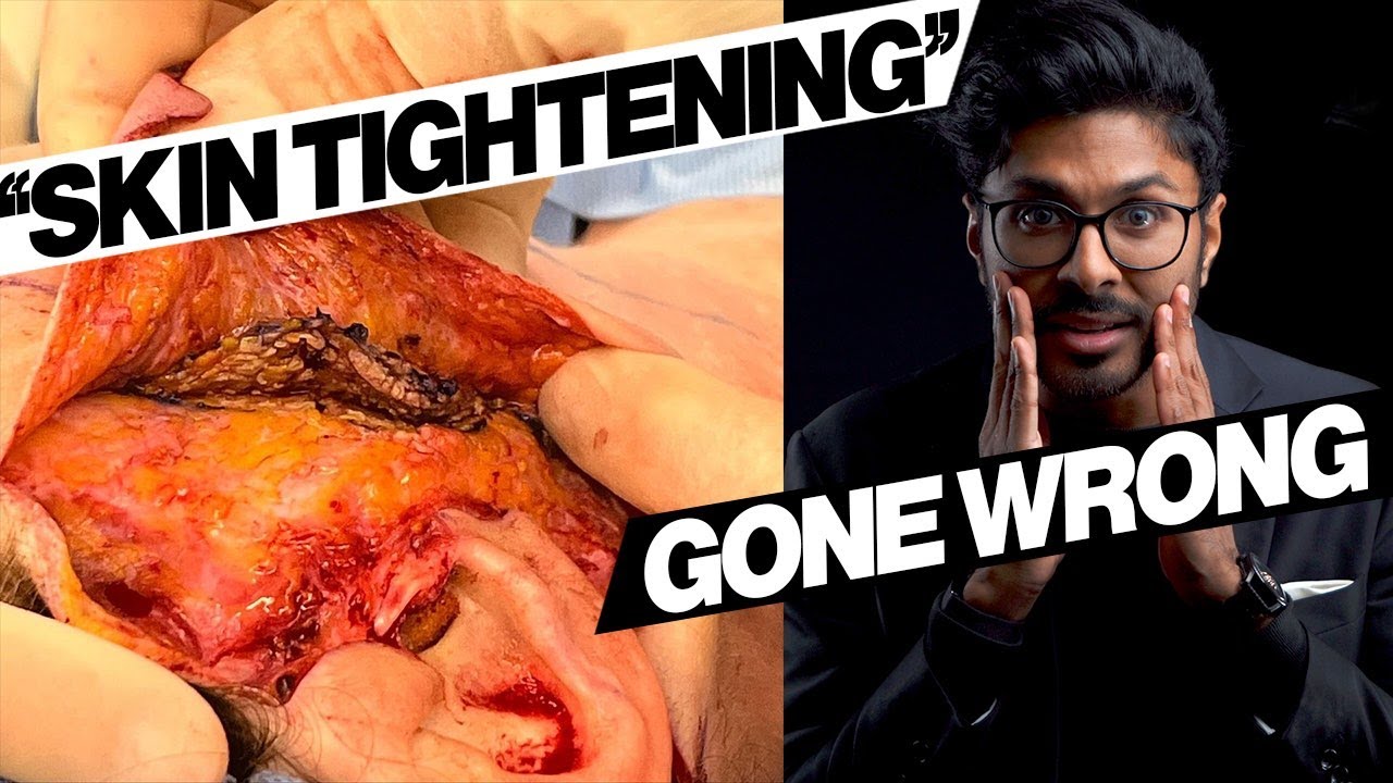 Inside Her Face After Tightening (Permanent Damage) - YouTube