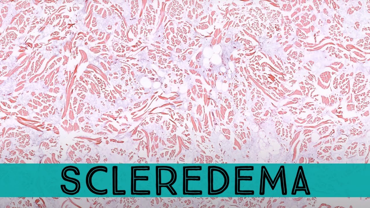 Scleredema (NOT pretibial myxedema or scleromyxedema) (pathology ...