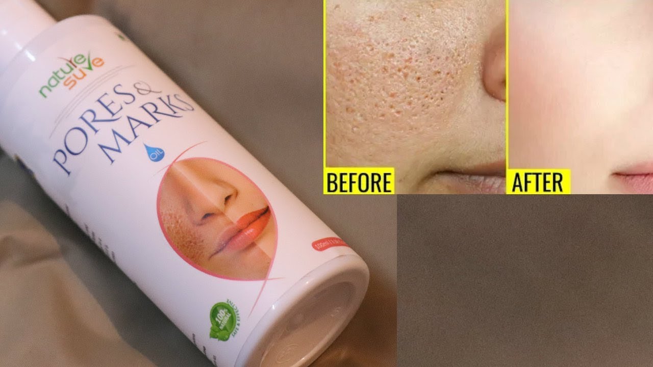 How to Get Rid of Large OPEN PORES | Nature Sure pores and marks oil ...