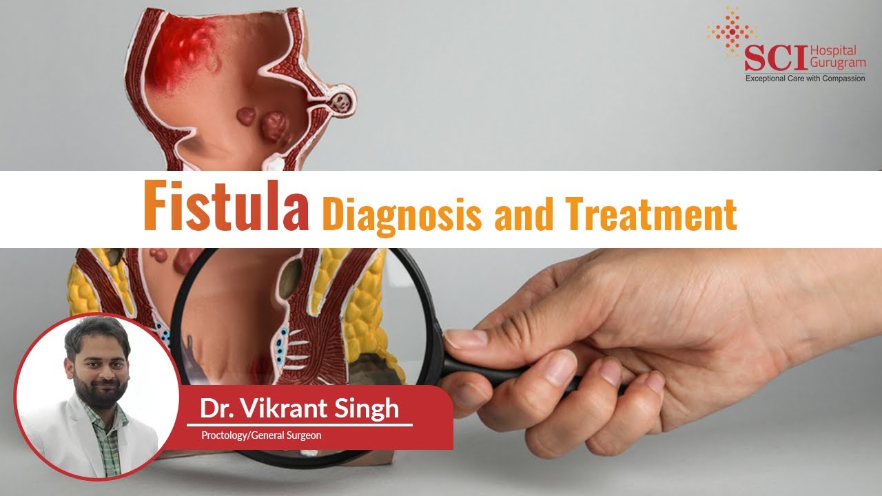 Fistula: Diagnosis & Treatment | Dr. Vikrant Singh | SCI Hospital - YouTube