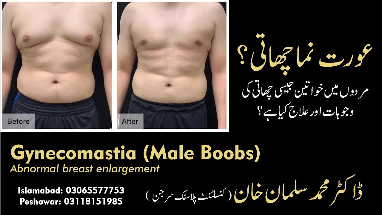 What is Gynecomastia or Male Boobs (From Types to Treatment - A ...