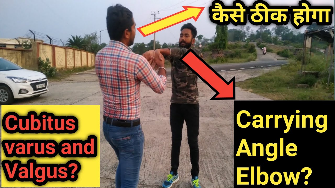 Carrying Angle। Cubitus Valgus। Cubitus Varus। केरिंग एंगल कैसे ठीक ...