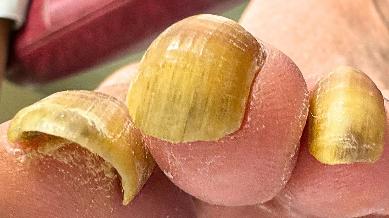 Cutting Neglected, Thick, Long Nails 😱 - YouTube