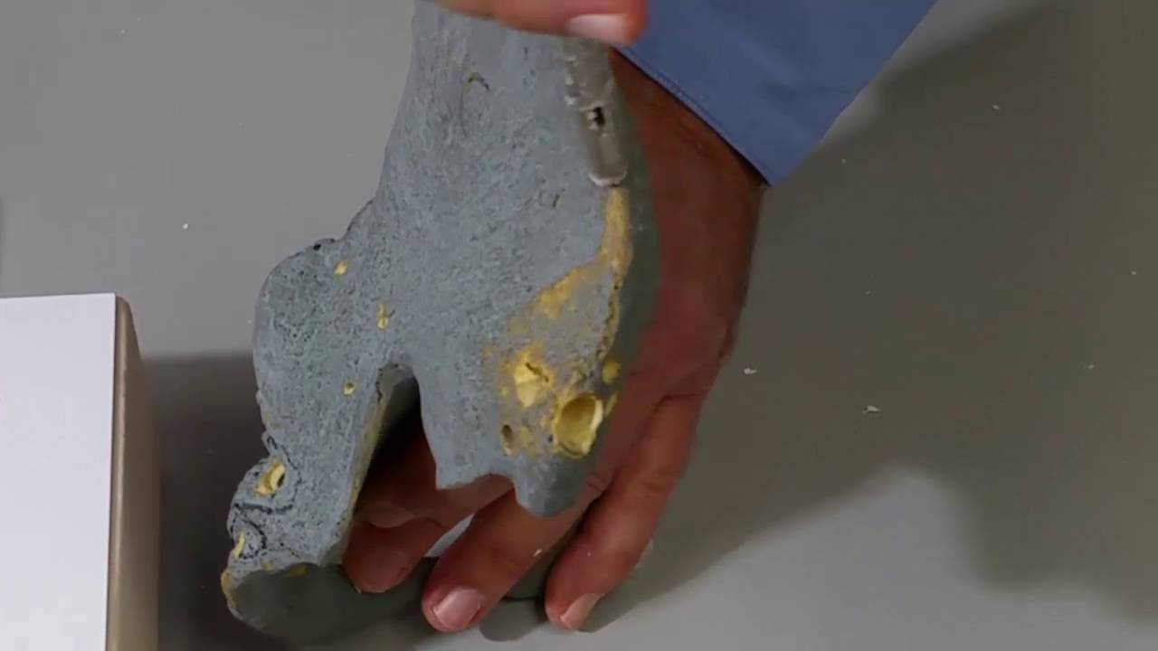Corex Bone Harvester, Iliac Crest Posterior Approach - YouTube