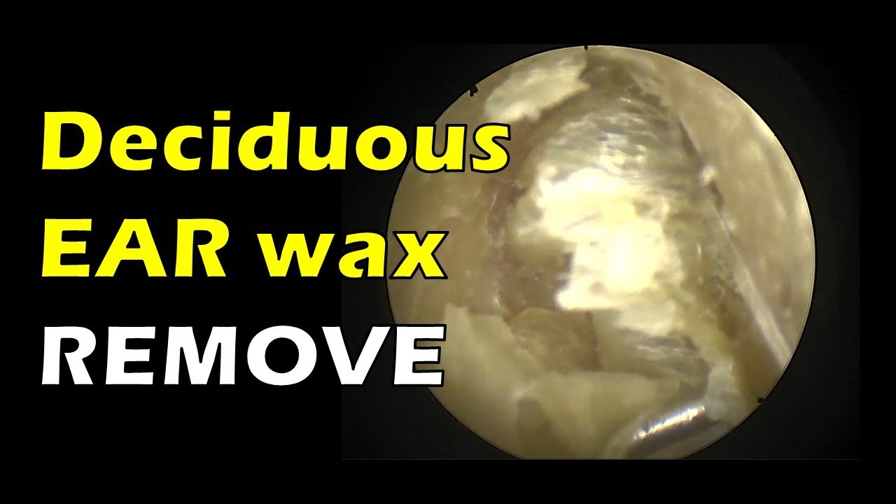 Deciduous EAR WAX removal - YouTube
