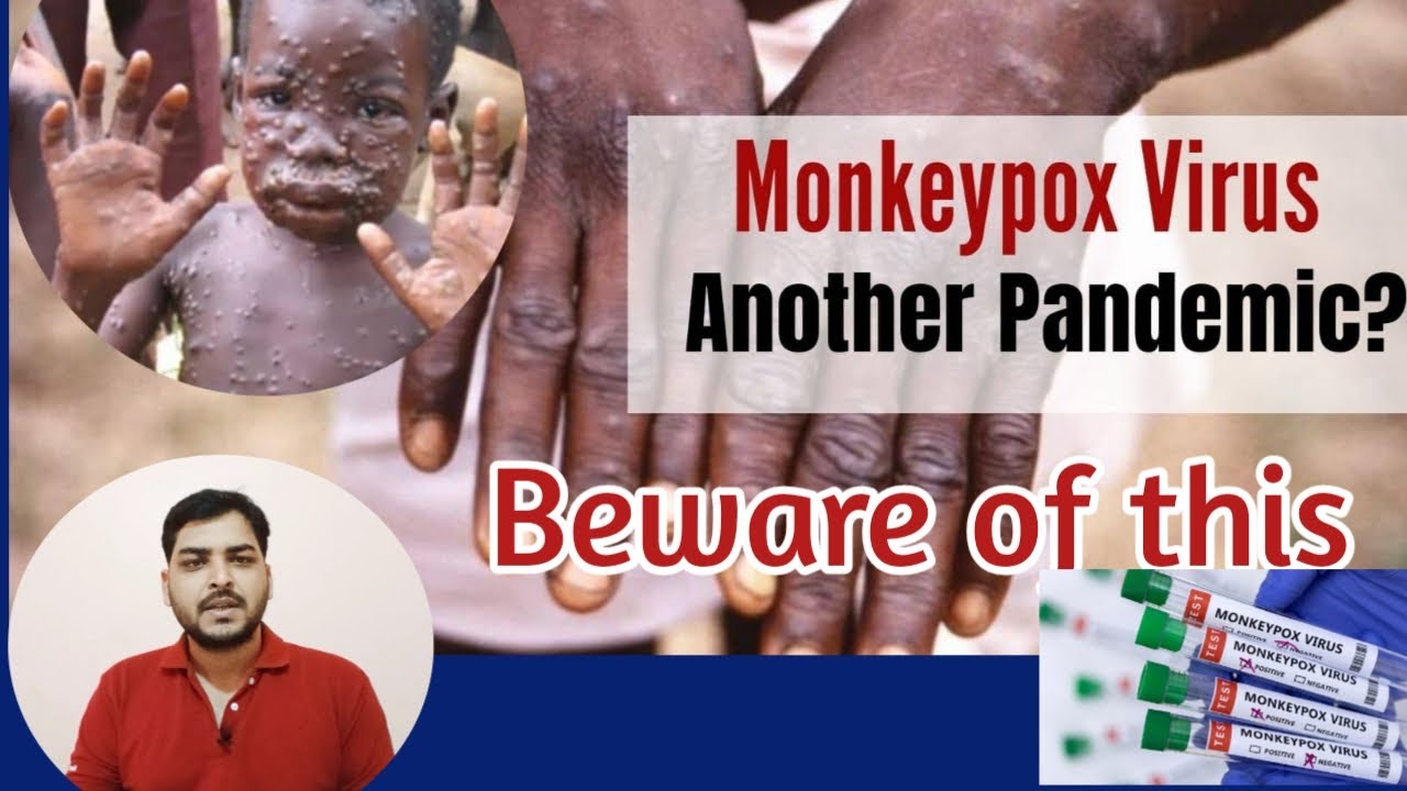 Monkeyfox virus//monkey fox disease in hindi //Cause , symptoms ...