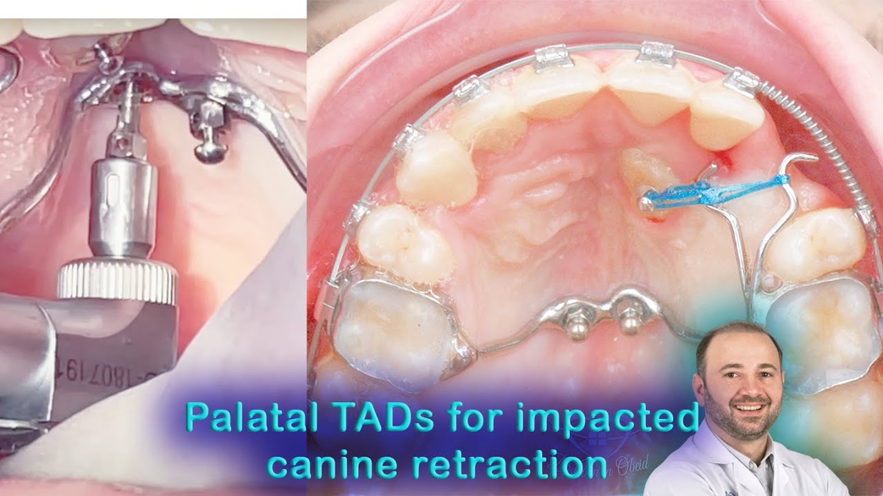 Palatal TADs to retract impacted canine, use mini implants palatelly for pulling out impacted ...
