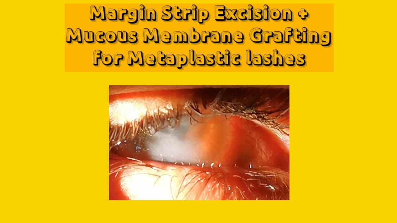 Margin Strip Excision + Mucous Membrane Grafting for Metaplastic lashes ...