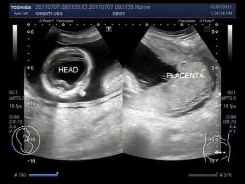 Ultrasound Video showing multiple fetal anomalies. - YouTube