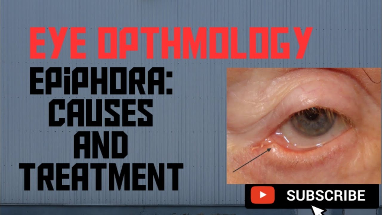 Epiphora: Causes and Treatment - YouTube