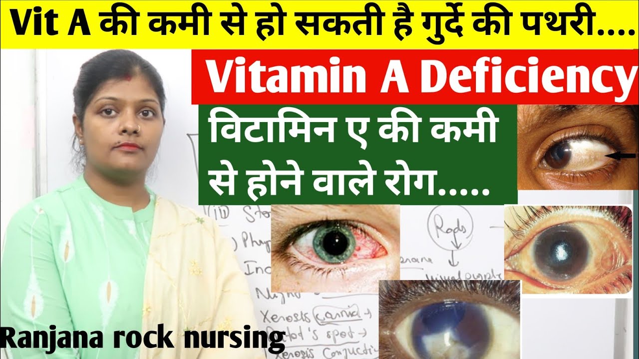 विटामिन ए की कमी से होने वाले रोग | What is vitamin A deficiency ...