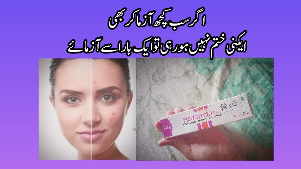 My personal experience with acdermin gell || best cream for acene pron ...