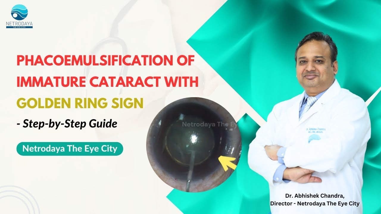 Phacoemulsification of Immature Cataract with Golden Ring Sign | Step ...