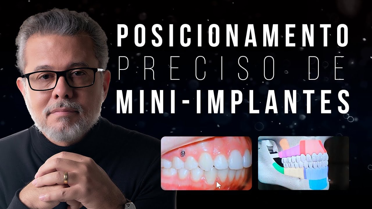 Pontos Chaves na Instalação de Mini-Implantes - YouTube