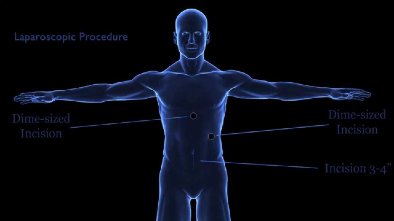 What is Minimally Invasive Colon Cancer Surgery? - YouTube
