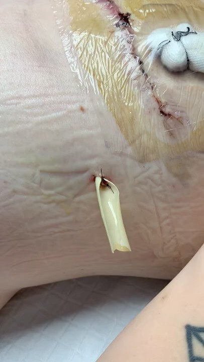 Penrose drain removal - YouTube