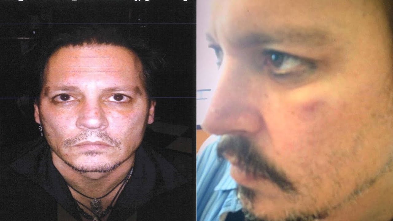 Photos Of Johnny Depps Injuries Presented To Court In Amber Heard Trial Day 4 Youtube