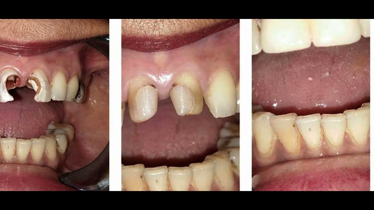 FRACTURED FRONT TEETH CORRECTION - YouTube