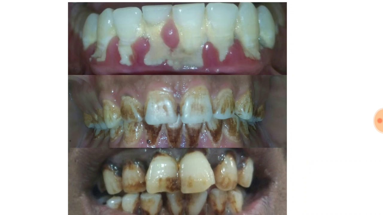 periodontitis in hindi,what is pyorrhoea पायरिया - YouTube