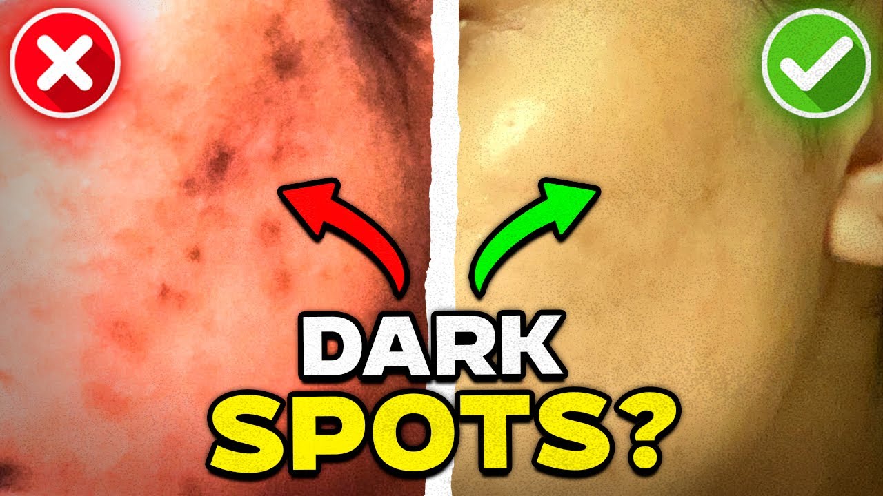 Dramatic Before & Afters - We Found The Best Dark Spot Corrector - YouTube