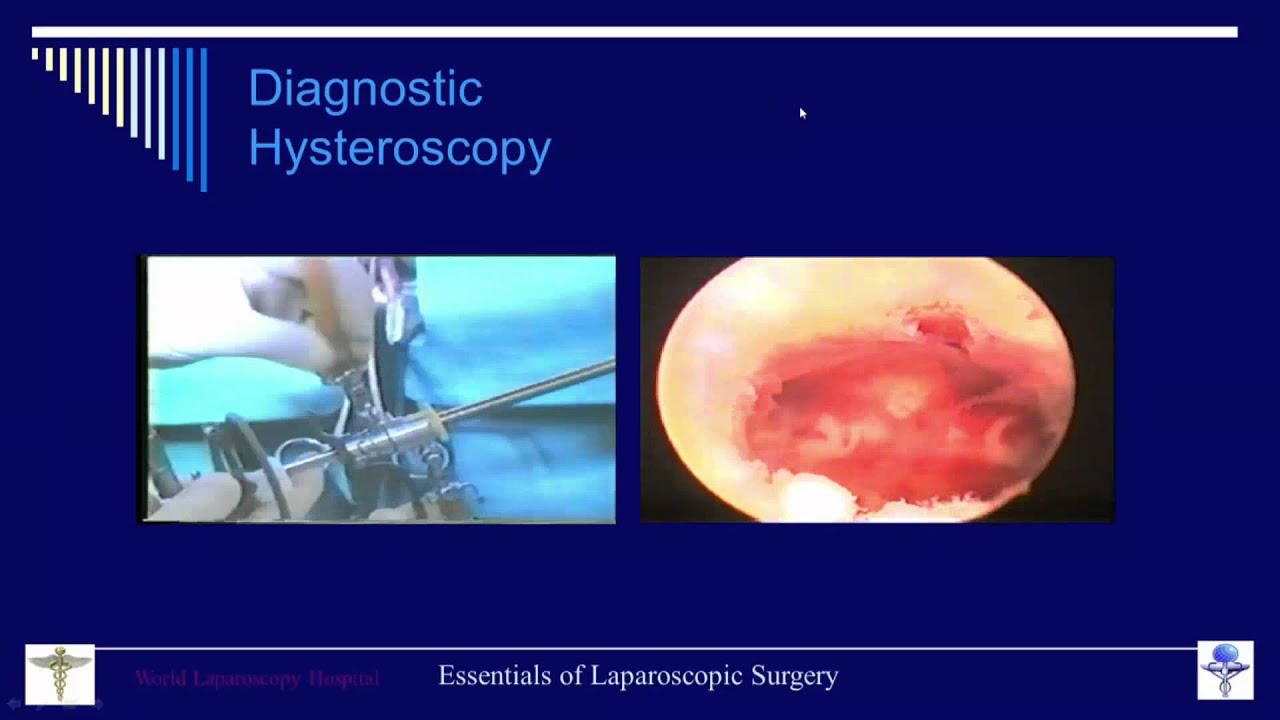 Master Class of Operative Hysteroscopy by Dr R K Mishra - YouTube