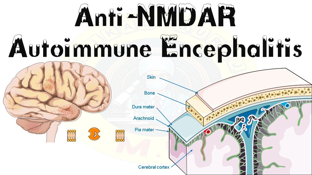 Anti-NMDAR Autoimmune Encephalitis: Definition, Symptoms ...
