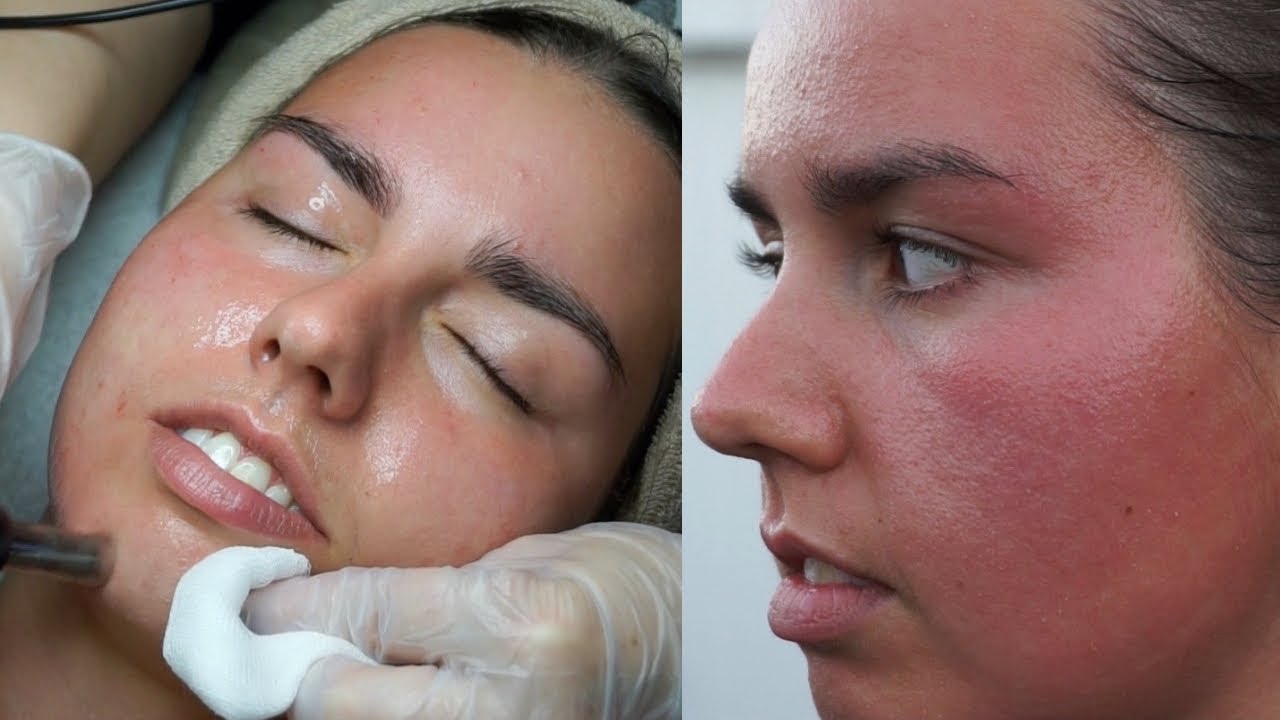 MY ALLERGIC REACTION TO DERMAPEN - YouTube