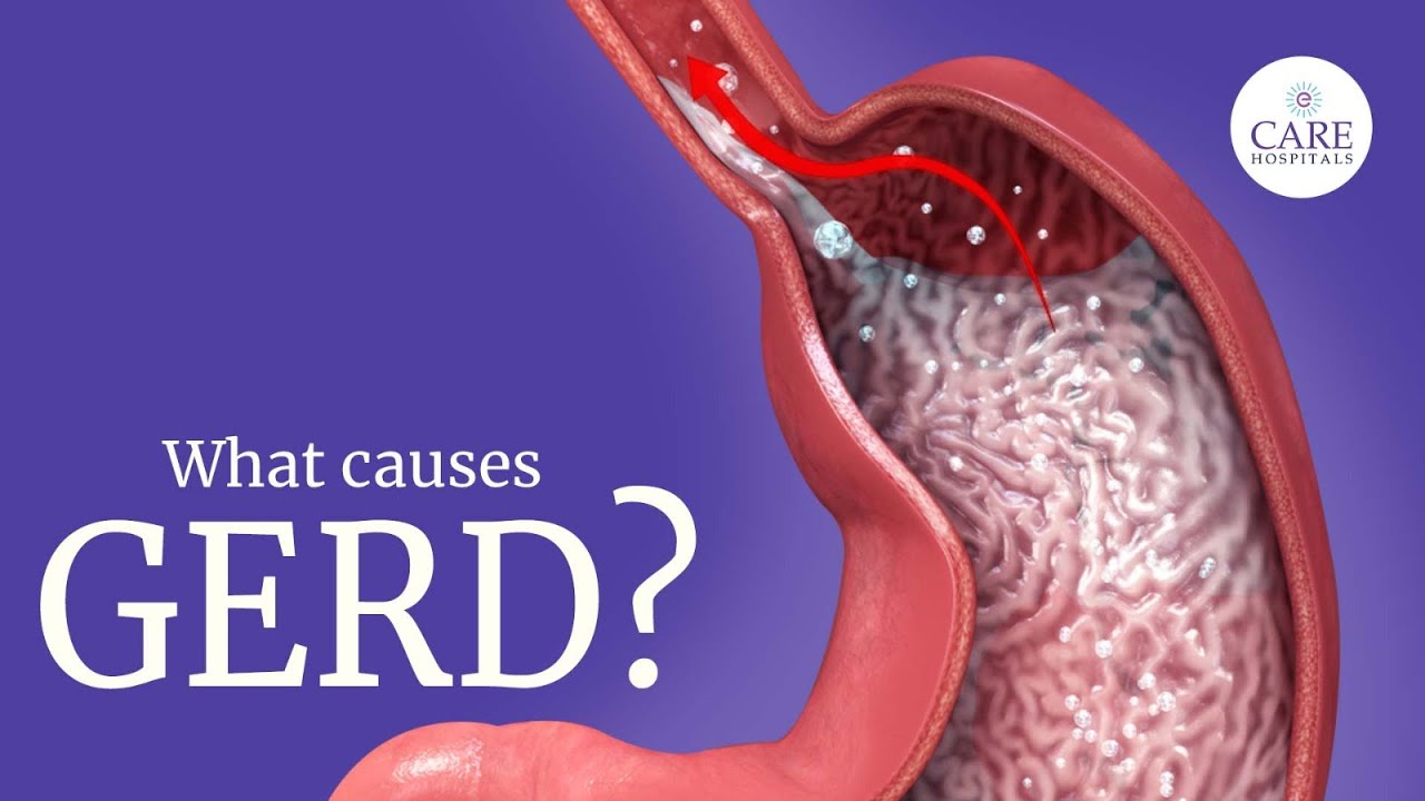 GERD - Gastroesophageal Reflux Disease, GERD Causes, Symptoms ...