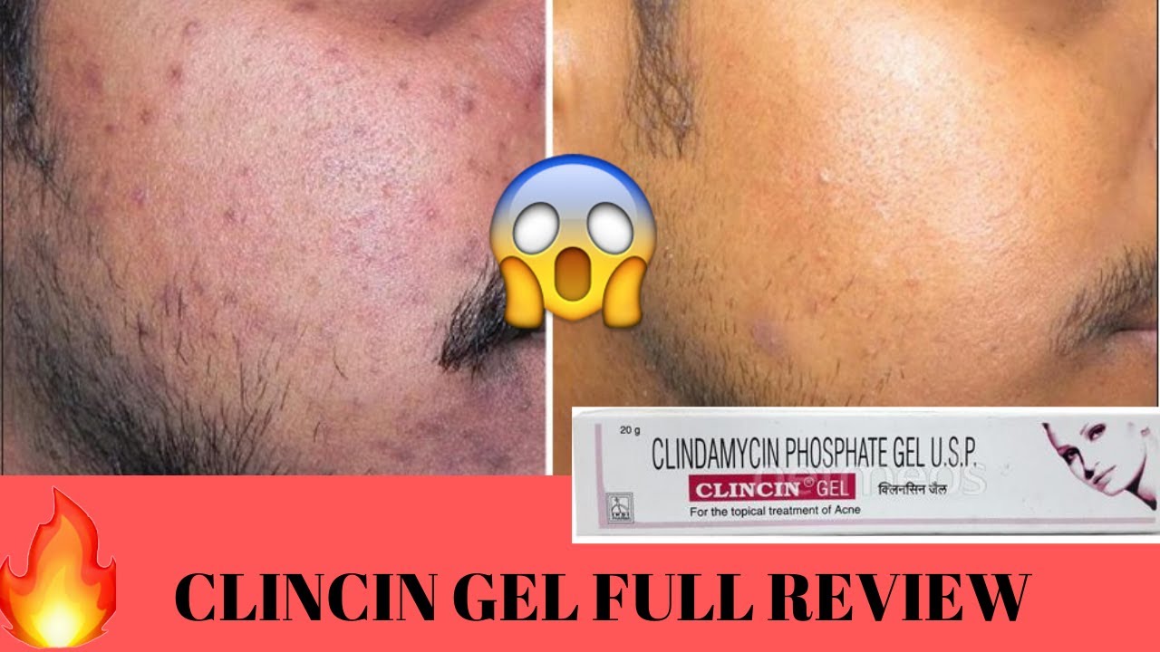 CLINCIN GEL FULL REVIEW IN DETAIL,क्या कील मुहासे होंगे गायब?😃😰🤨🤨 - YouTube