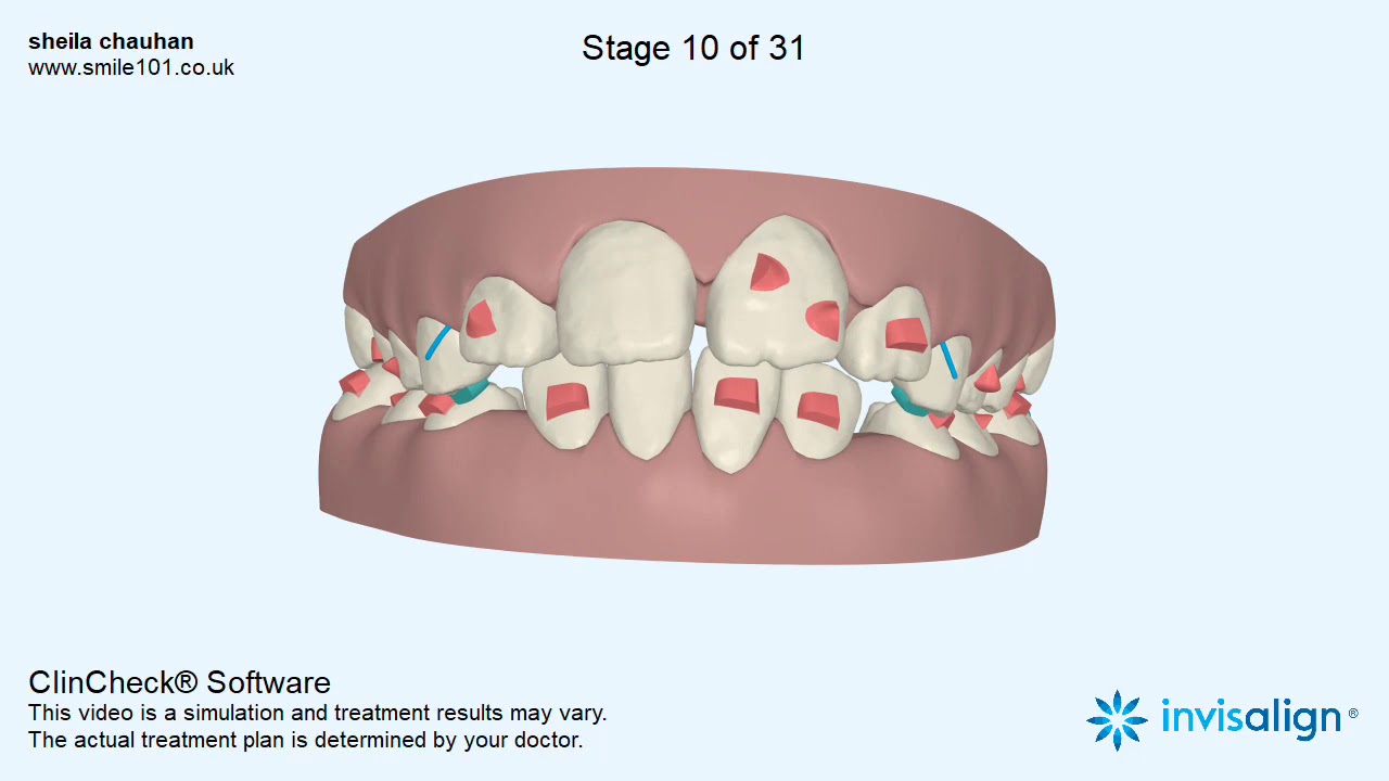 Invisalign first clincheck - YouTube