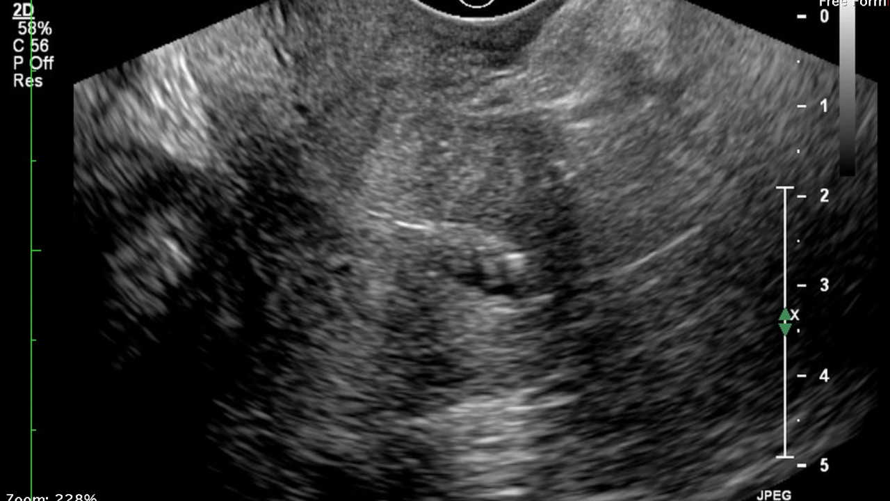 Saline Sonohysterogram endometrial polyp - YouTube