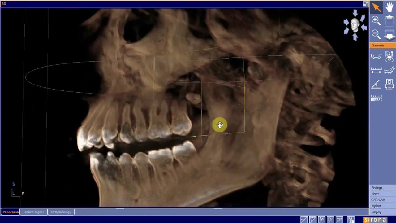 Radiographic interpretation of mandibular condyle fracture - YouTube