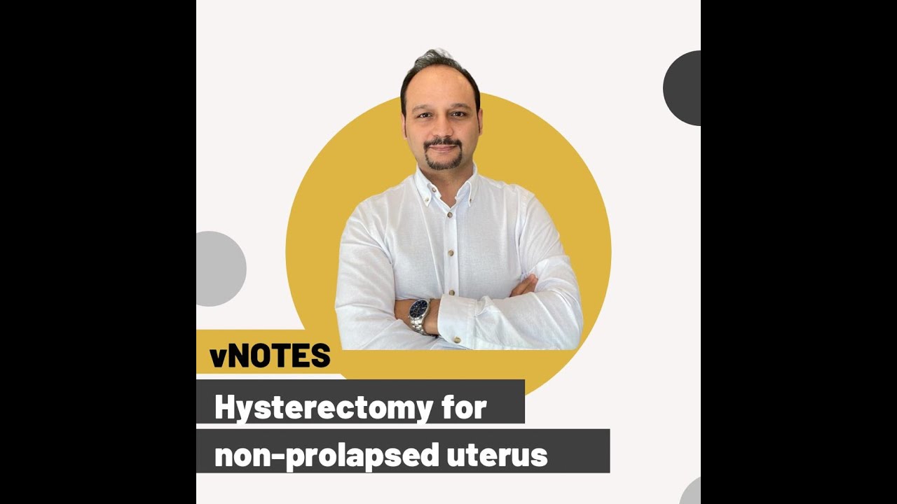 vNOTES simple hysterectomy for a non-prolapsed uterus in 23 minutes ...
