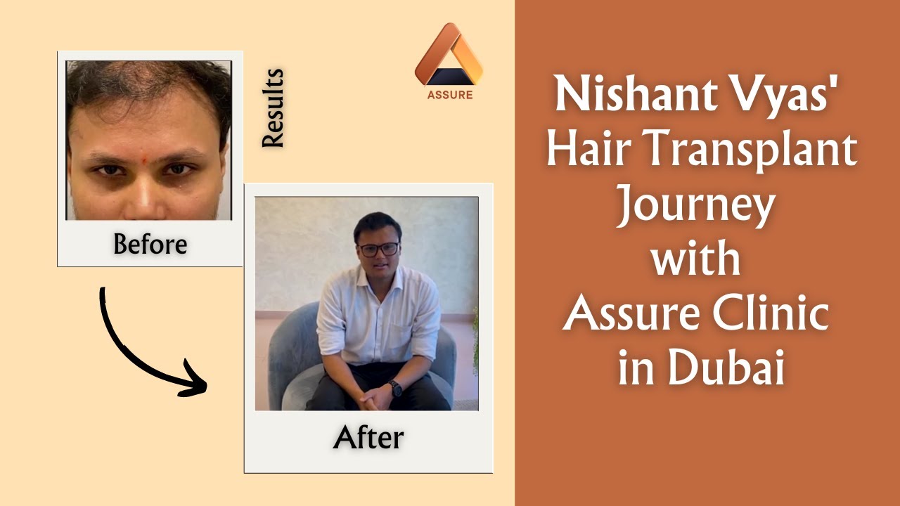 Nishant Vyas' Hair Restoration Journey: A Transformation Guided by ...