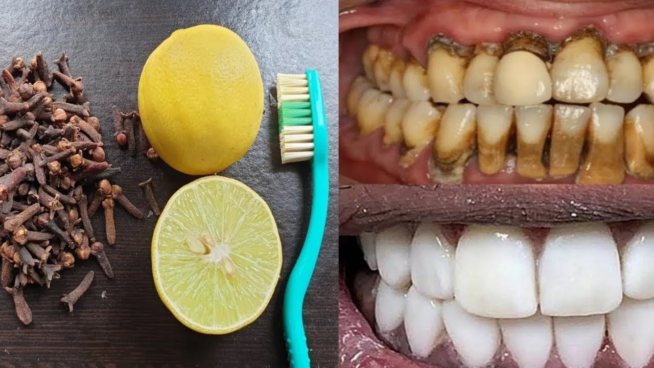 Esta increíble receta aclarará los dientes amarillos sucios como en ...