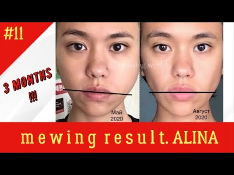 Mewing: fixing facial asymmetry🌺 - YouTube