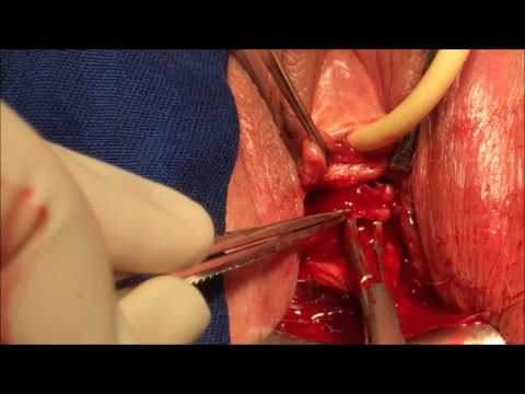 Double opposite tape incision for obstructive sling