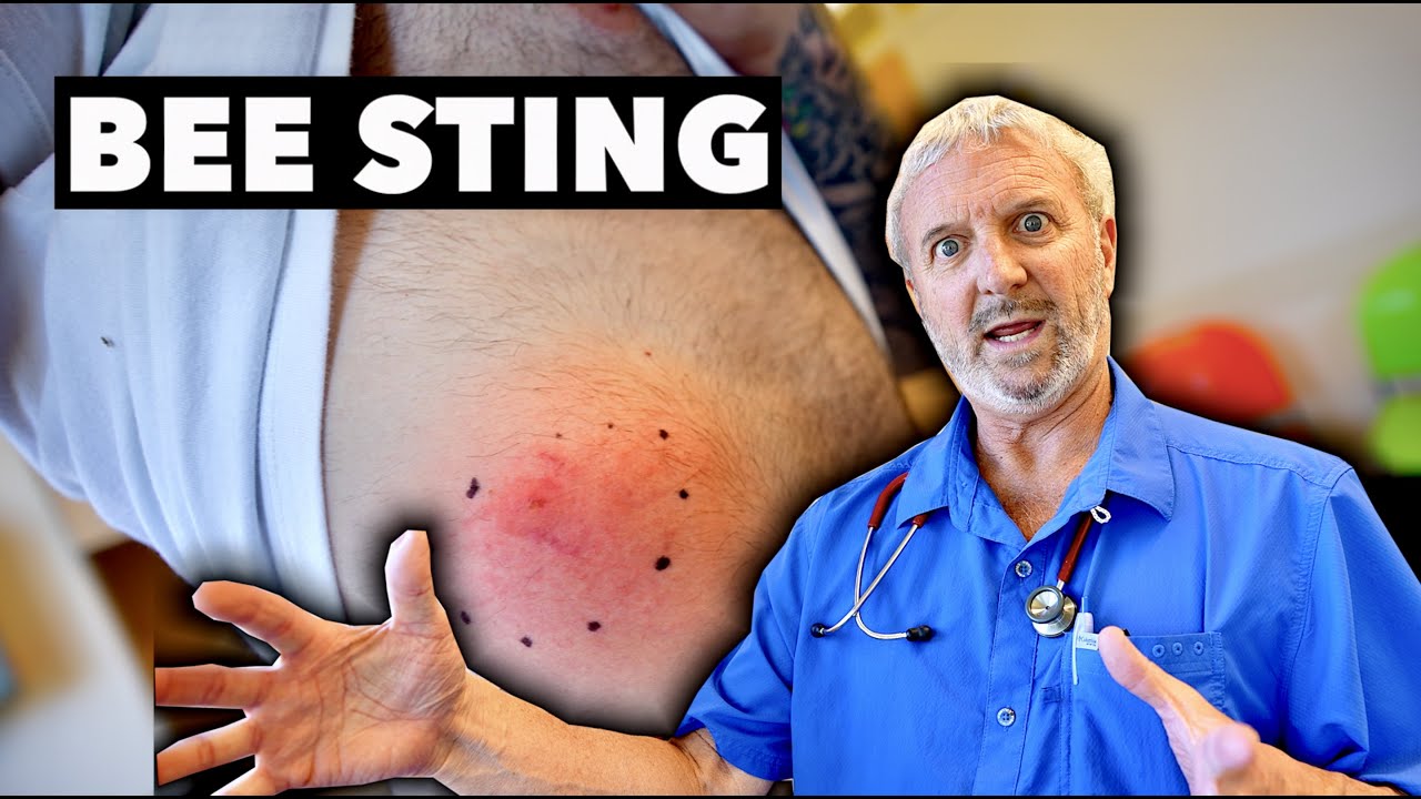 MASSIVE BEE STING! (What to Look Out for When You Get Stung) feat. My ...
