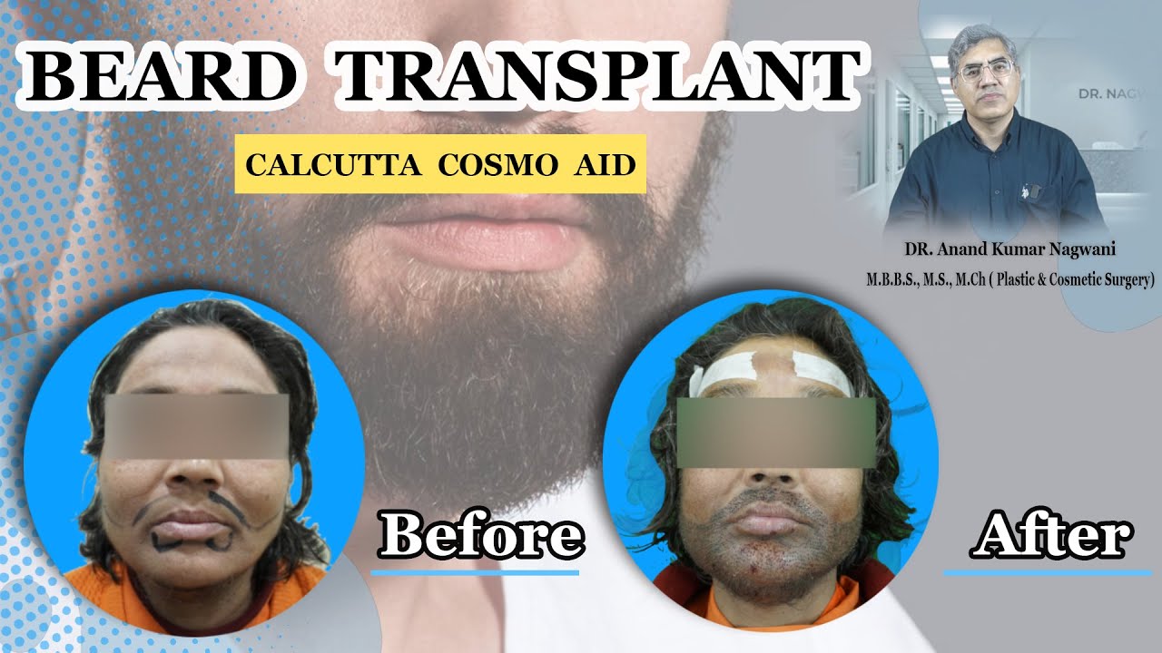 Beard Transplant in Kolkata | @ Very Lowest Cost | Result of Beard ...