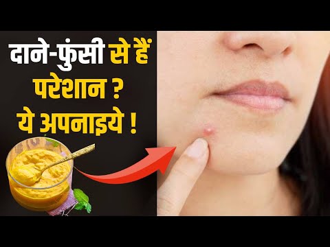 चेहरे पर दाने-फुंसी से परेशान हैं तो ये रामबाण इलाज जरुर अपना लीजिए !