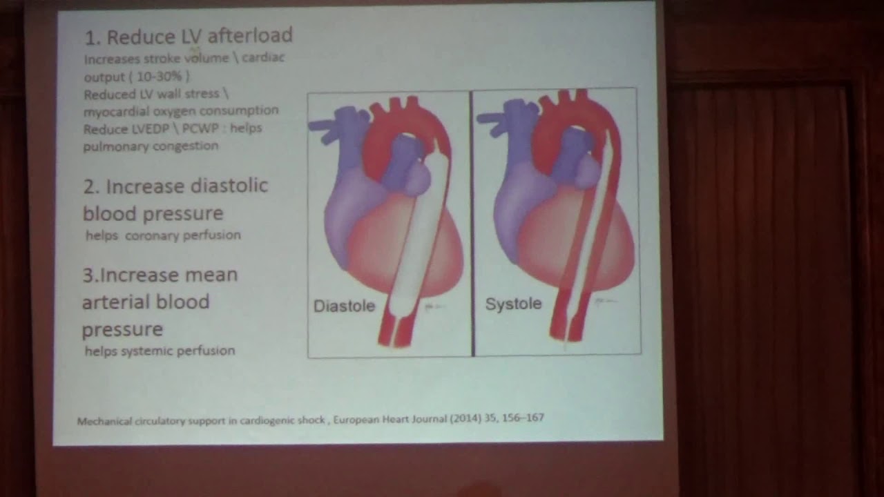 Temporary Circulatory Support TCS in Cardiogenic Shock - YouTube