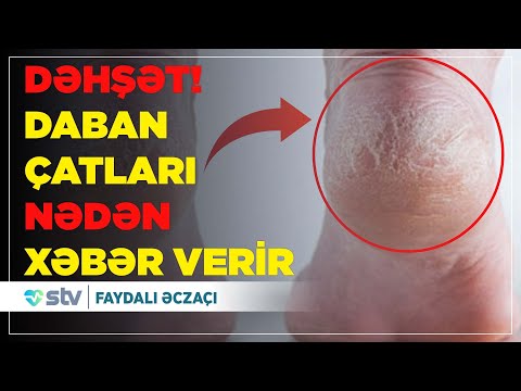 ŞOK! Dabanda çatlar nədən yaranır ?