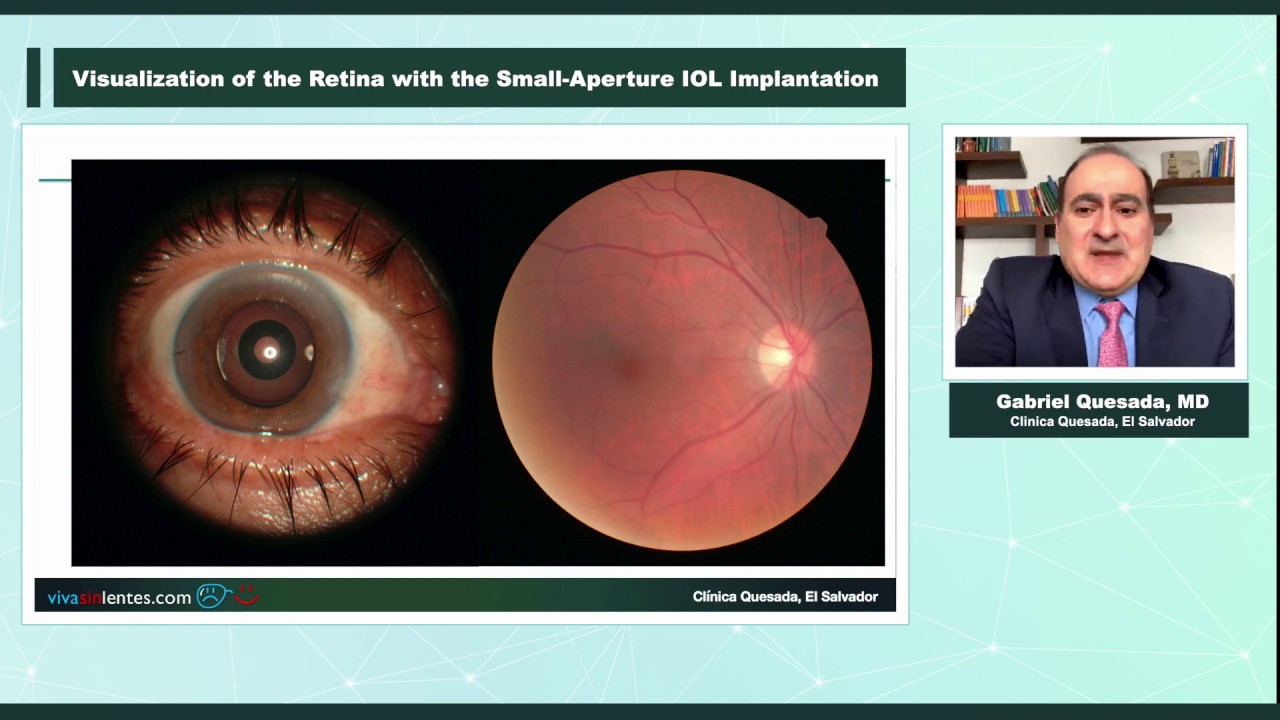 Visualization of the Retina with the Small-Aperture IOL Implantation ...