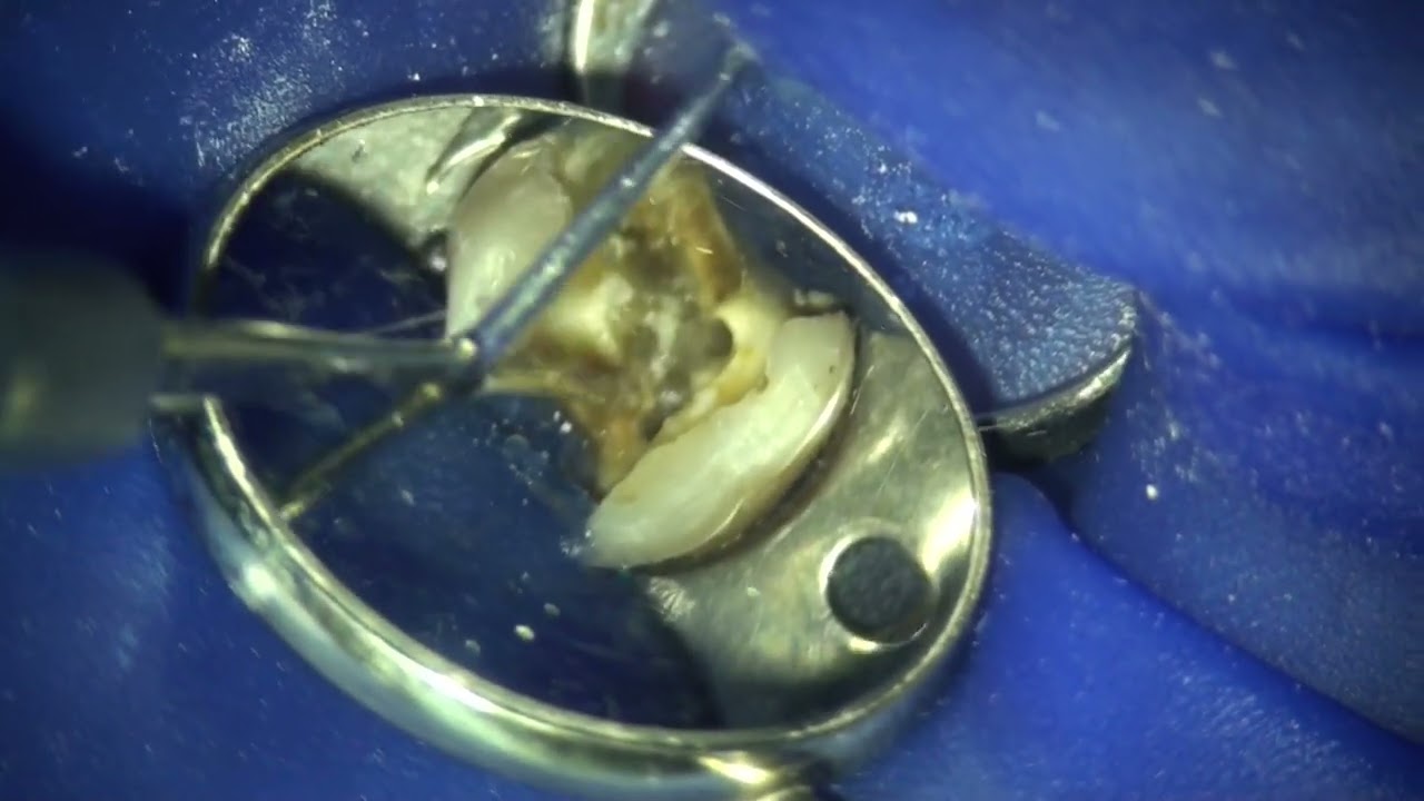 Root canal treatment 26 with MB2 - YouTube