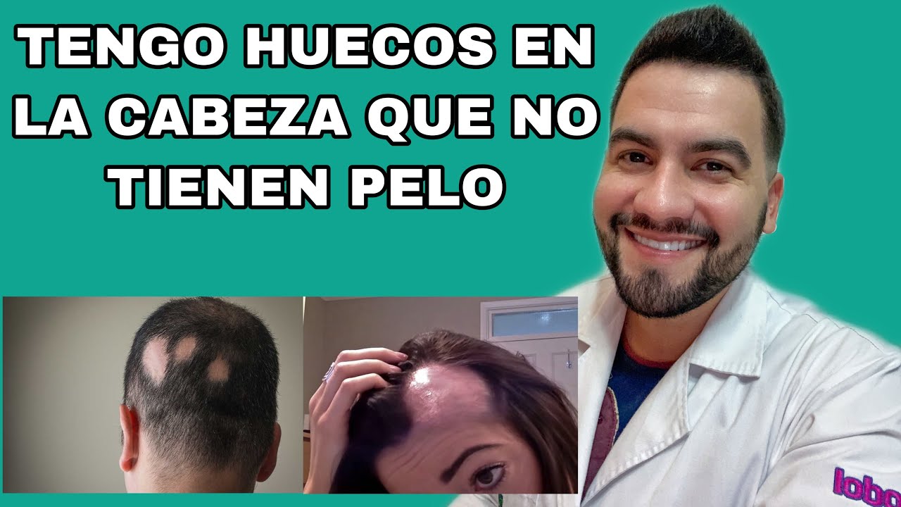 Porque se me hacen huecos sin pelo en la cabeza / Alopecia Areata ...