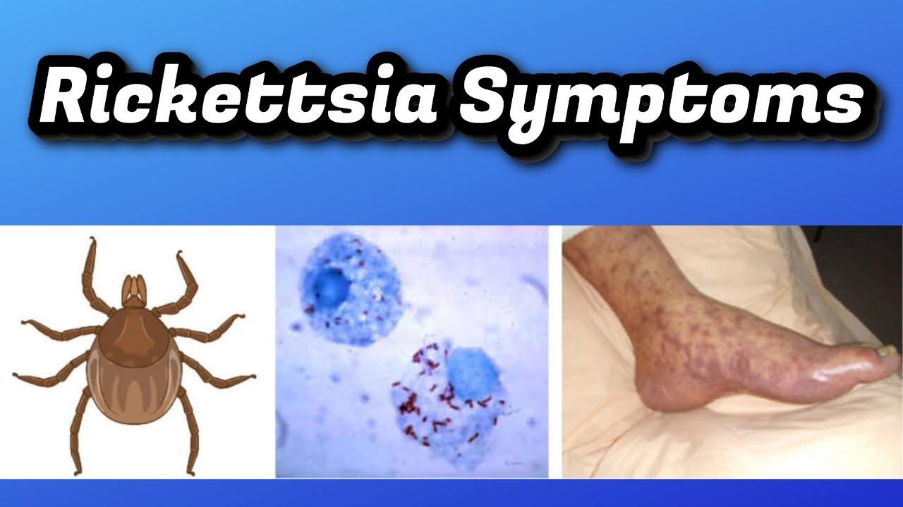 Rickettsia Symptoms - YouTube