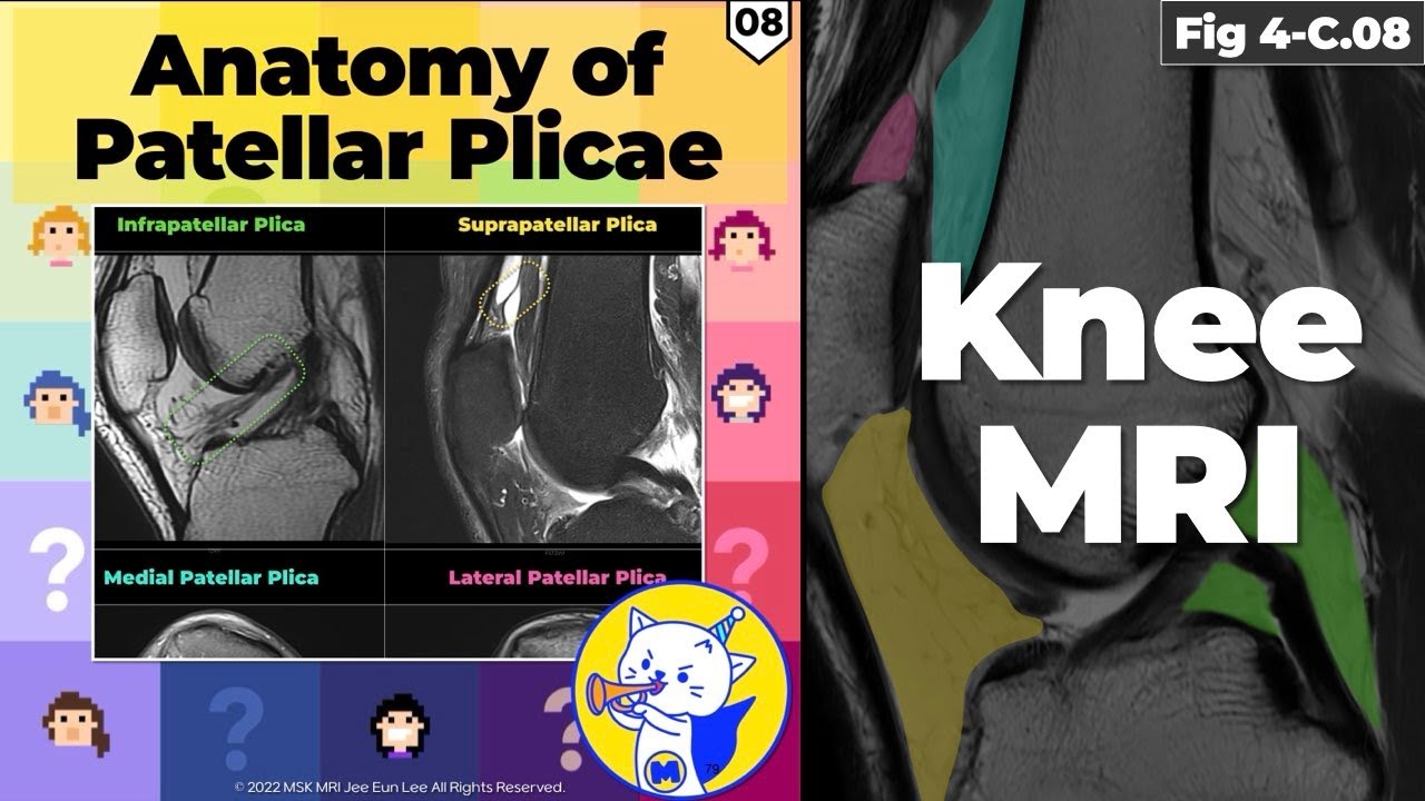 (Fig 4-C.08) Anatomy of Patellar Plicae - YouTube