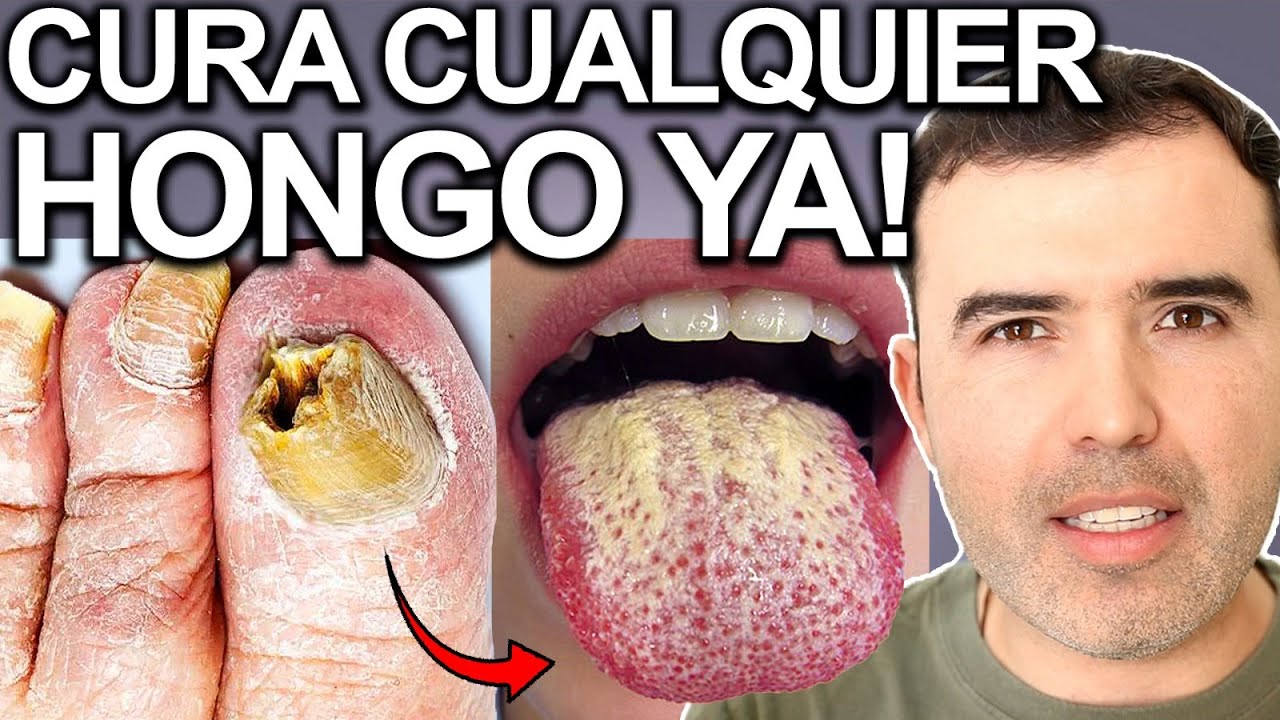 CURA CUALQUIER HONGO YA! - Como Eliminar Y Hacer Una Limpieza De Hongos ...