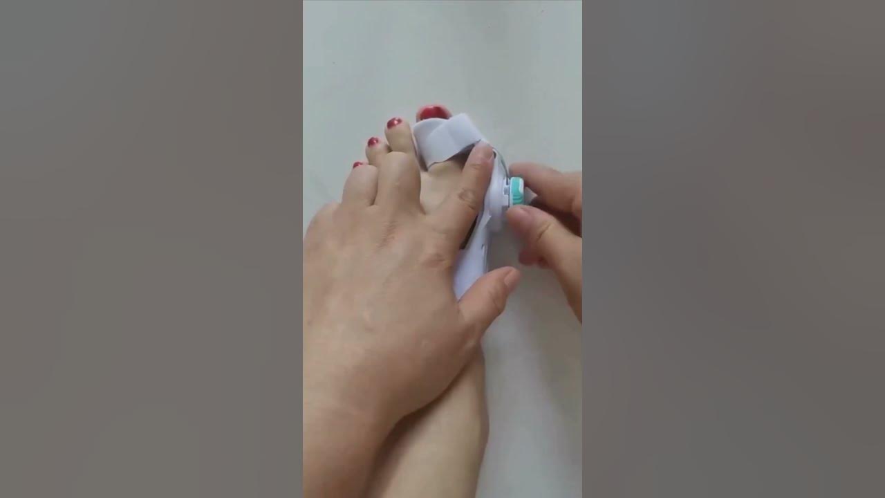 اصلاح انحراف انگشت شصت پا با هالگوس پیچی Youtube